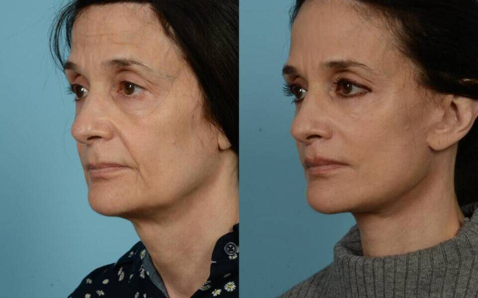 Rejuvenate Your Jawline: The Power Of A Lower Facelift