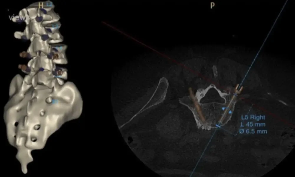 AI’s Impact On Surgical Planning For Spinal Instability